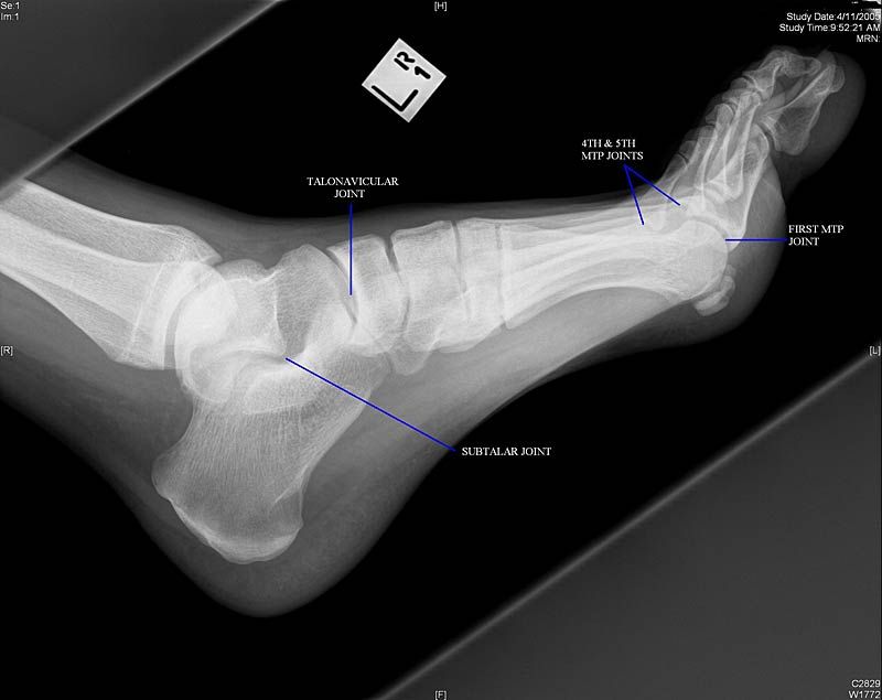 Heel Spur